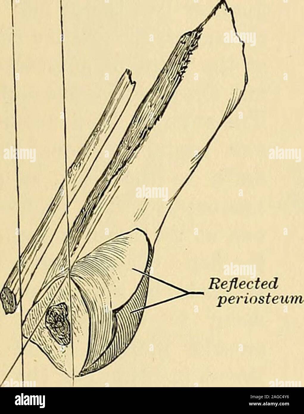 . Operative surgery. sion through the integument and subcutaneous ...
