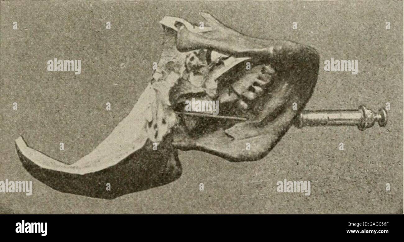 . Local and regional anesthesia; with chapters on spinal, epidural ...