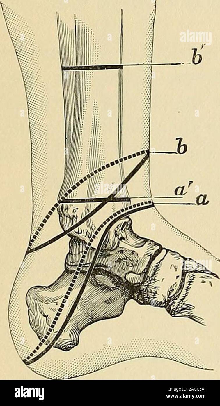 . Operative surgery. place, a distance equal to three fourths of the ...