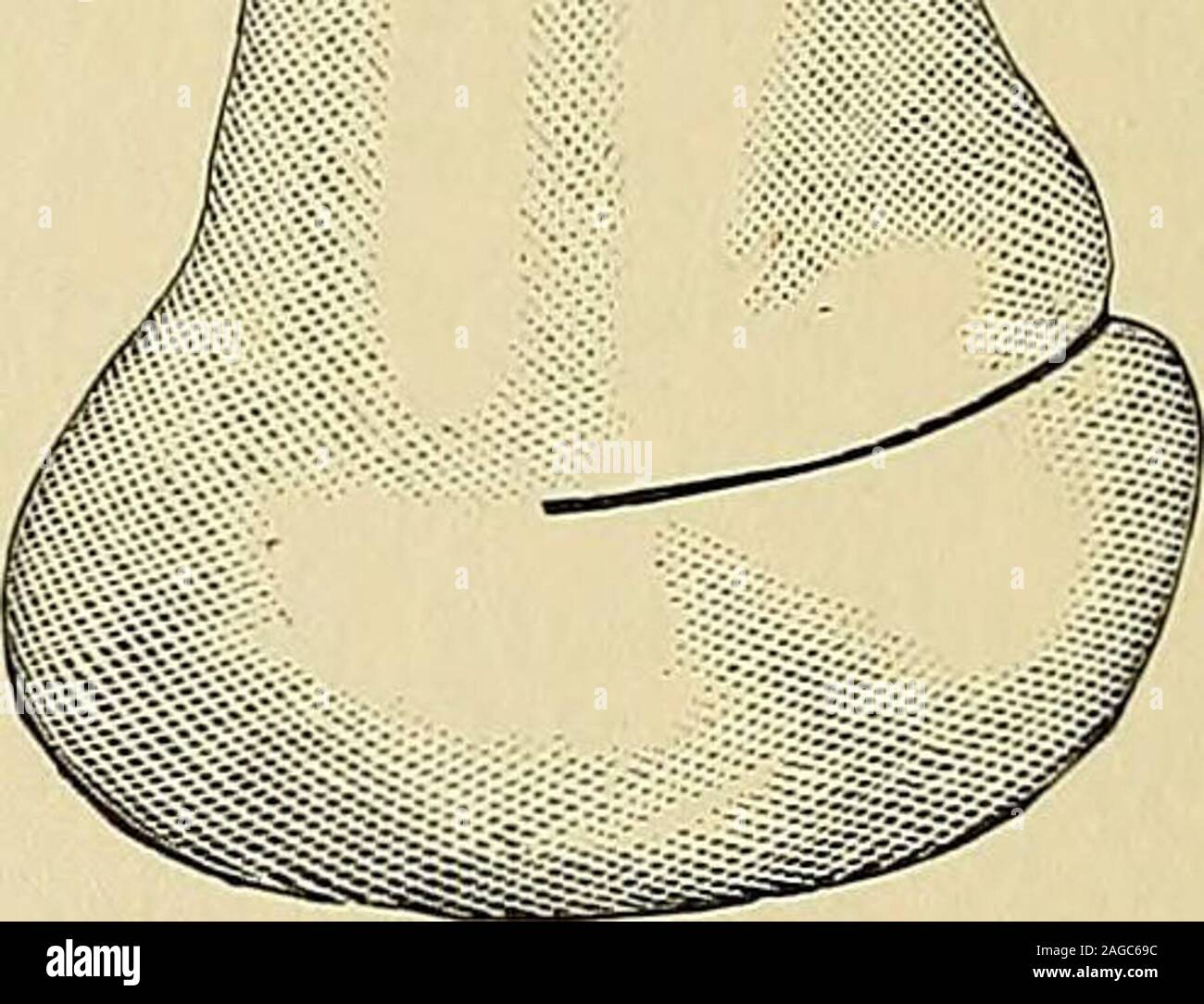 . Operative surgery. FiG. 601.—Sawn bones in Le Forts modification. Fig ...