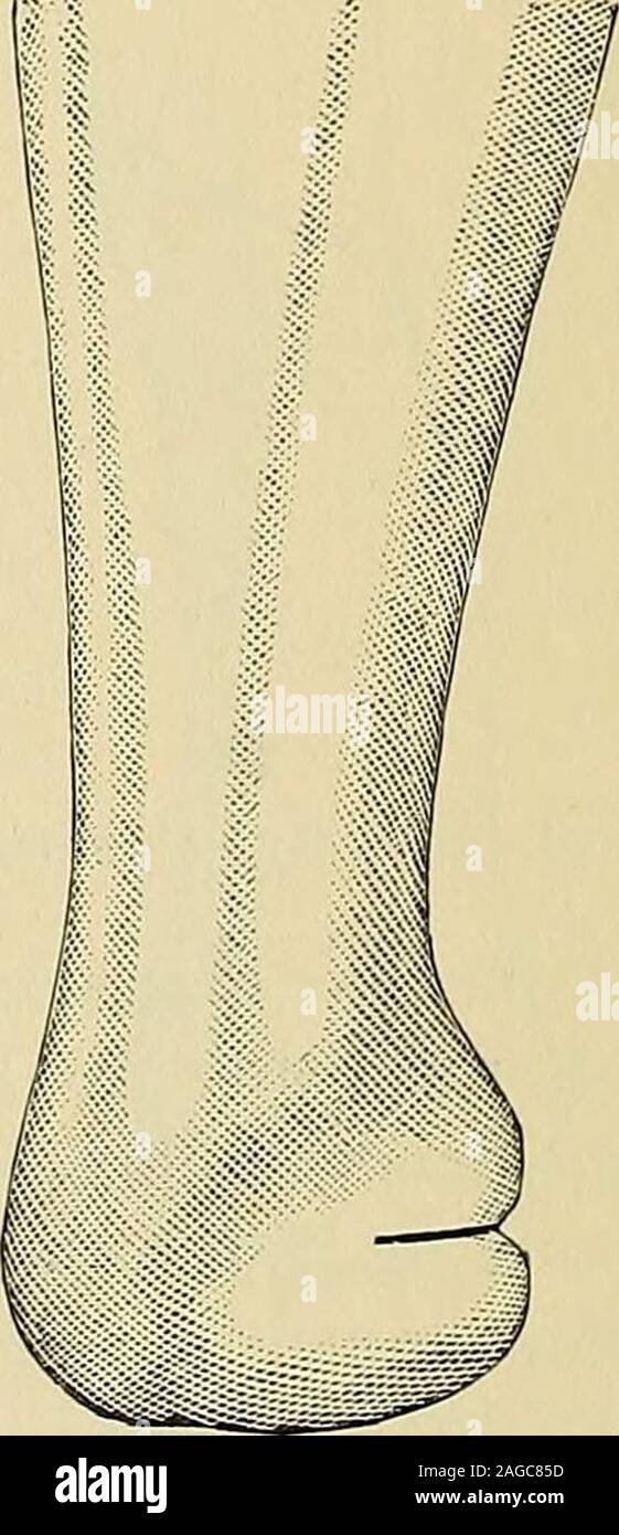 Syme amputation hi-res stock photography and images - Alamy