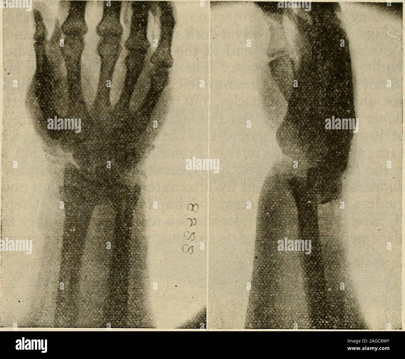 Styloid fracture hi-res stock photography and images - Alamy