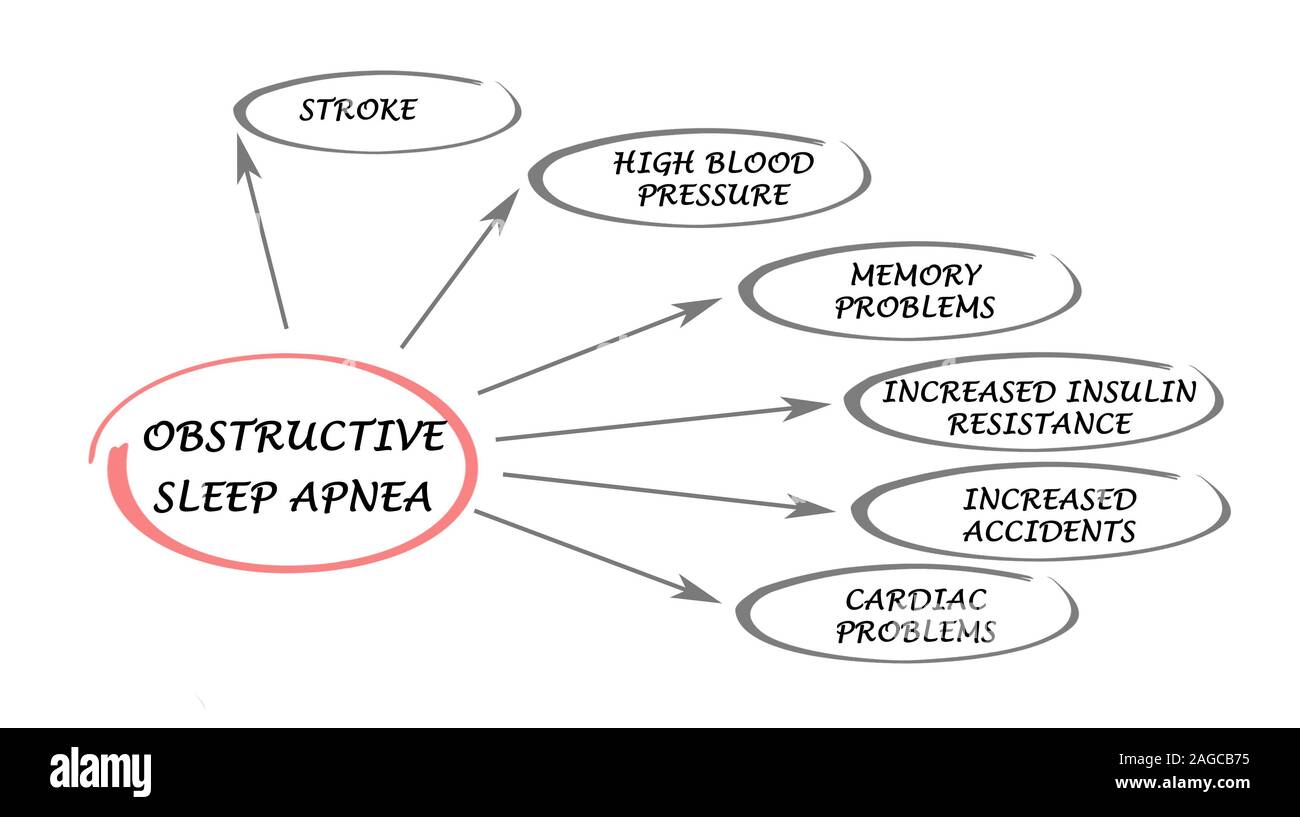 Obstructive Sleep Apnea Stock Photo - Alamy