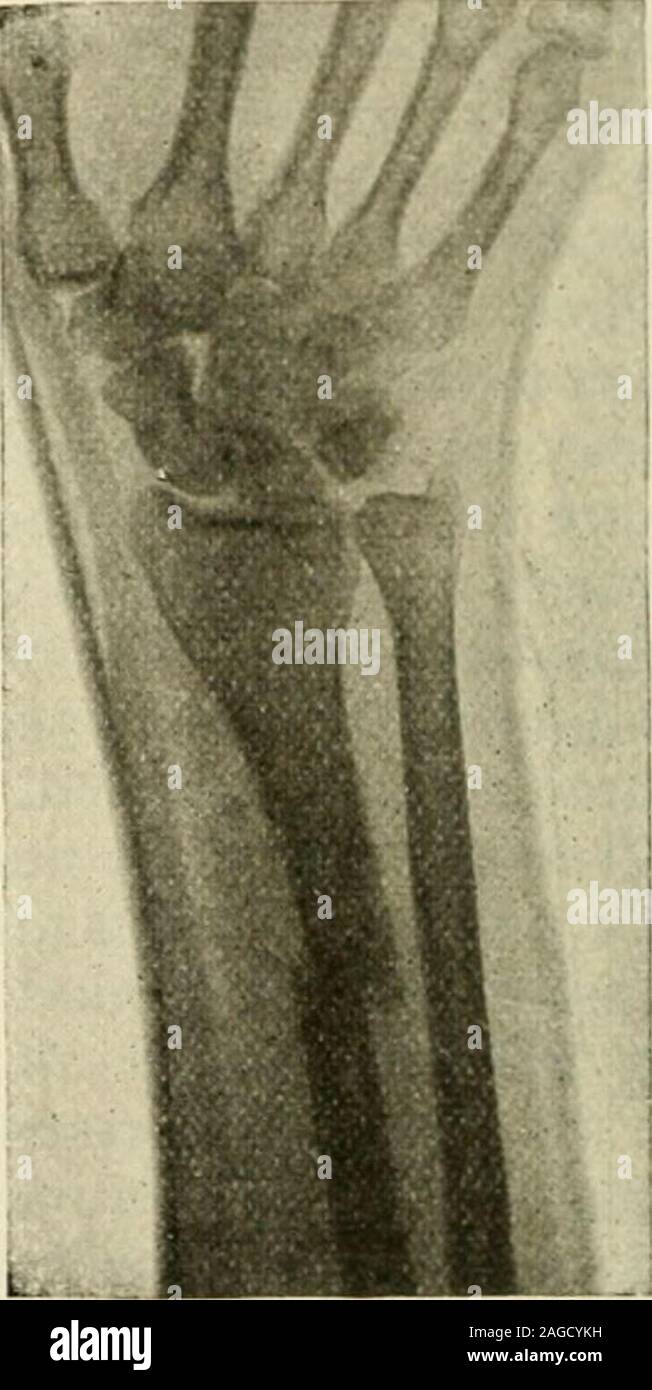 Supinator muscle hi-res stock photography and images - Alamy