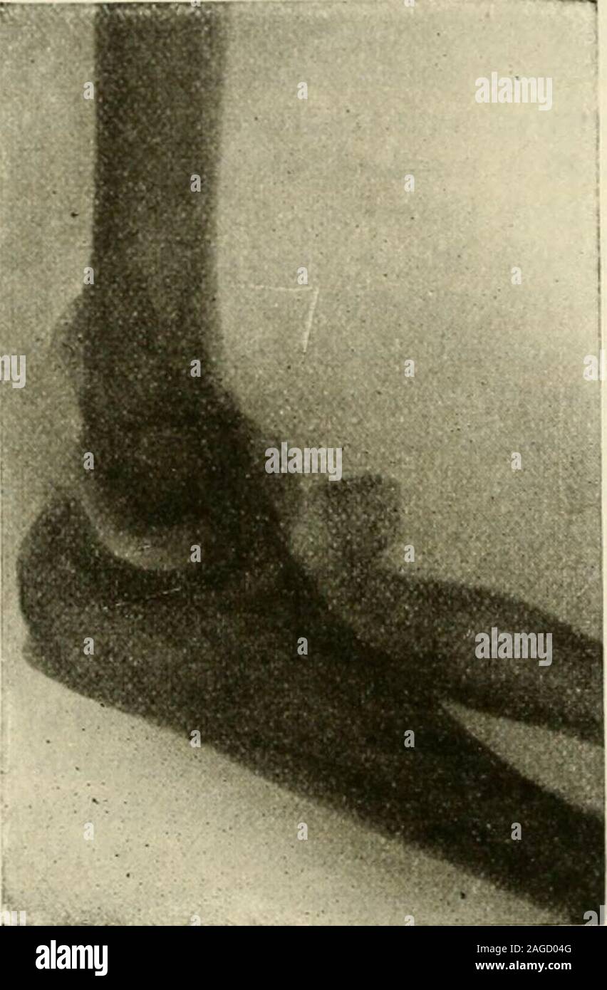 Supinator muscle hi-res stock photography and images - Alamy