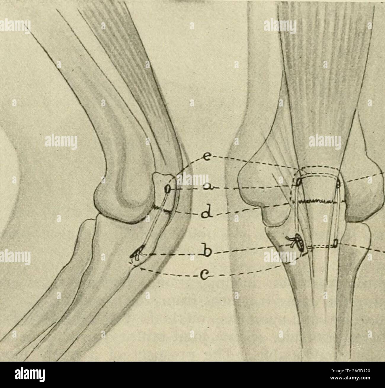 . Modern surgery, general and operative. oyed a gloveto which strings ...