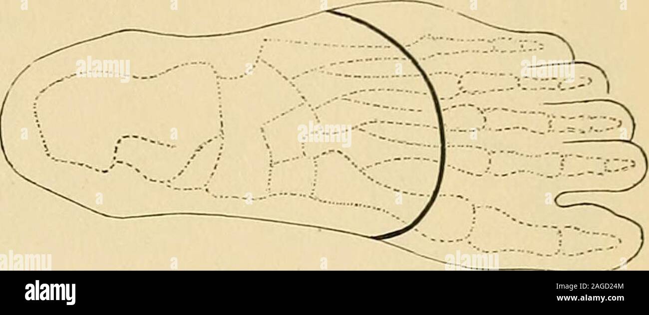 . Operative surgery. FiG. 575.—Choparts amputation, inner incision ...