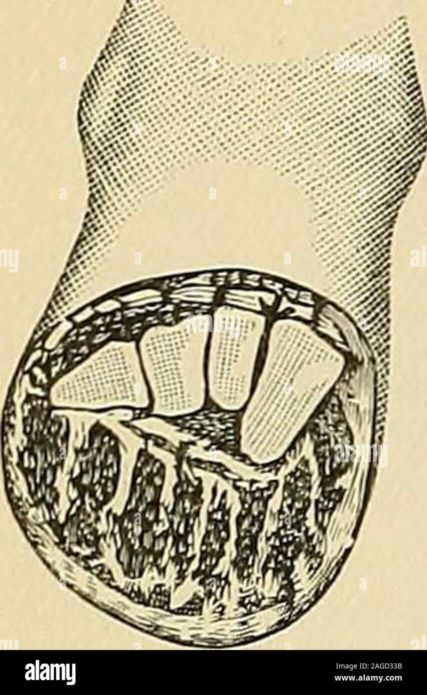 . Operative surgery. Fig. 572.—Separating the second metatarsal. Fig ...