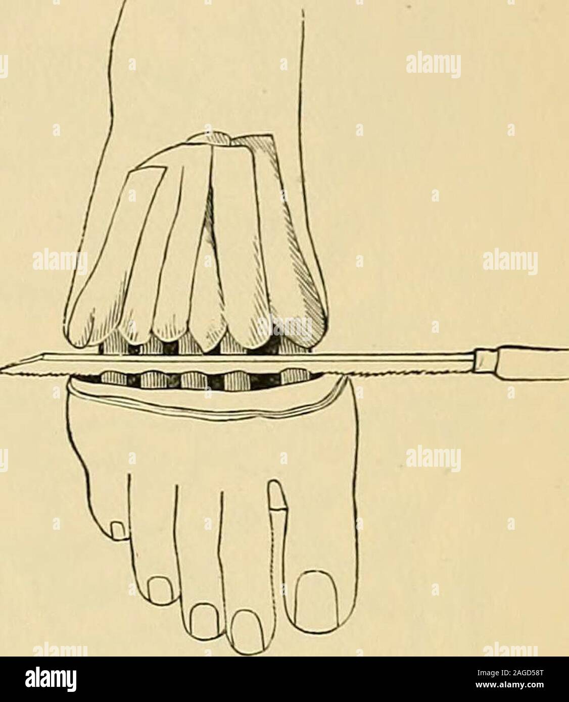 . Operative surgery. In this in-stance the incision is begun on the ...