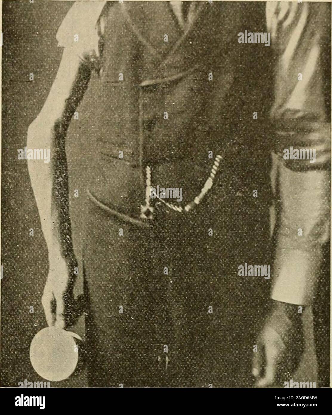 . Modern surgery, general and operative. the triceps, biceps, and ...