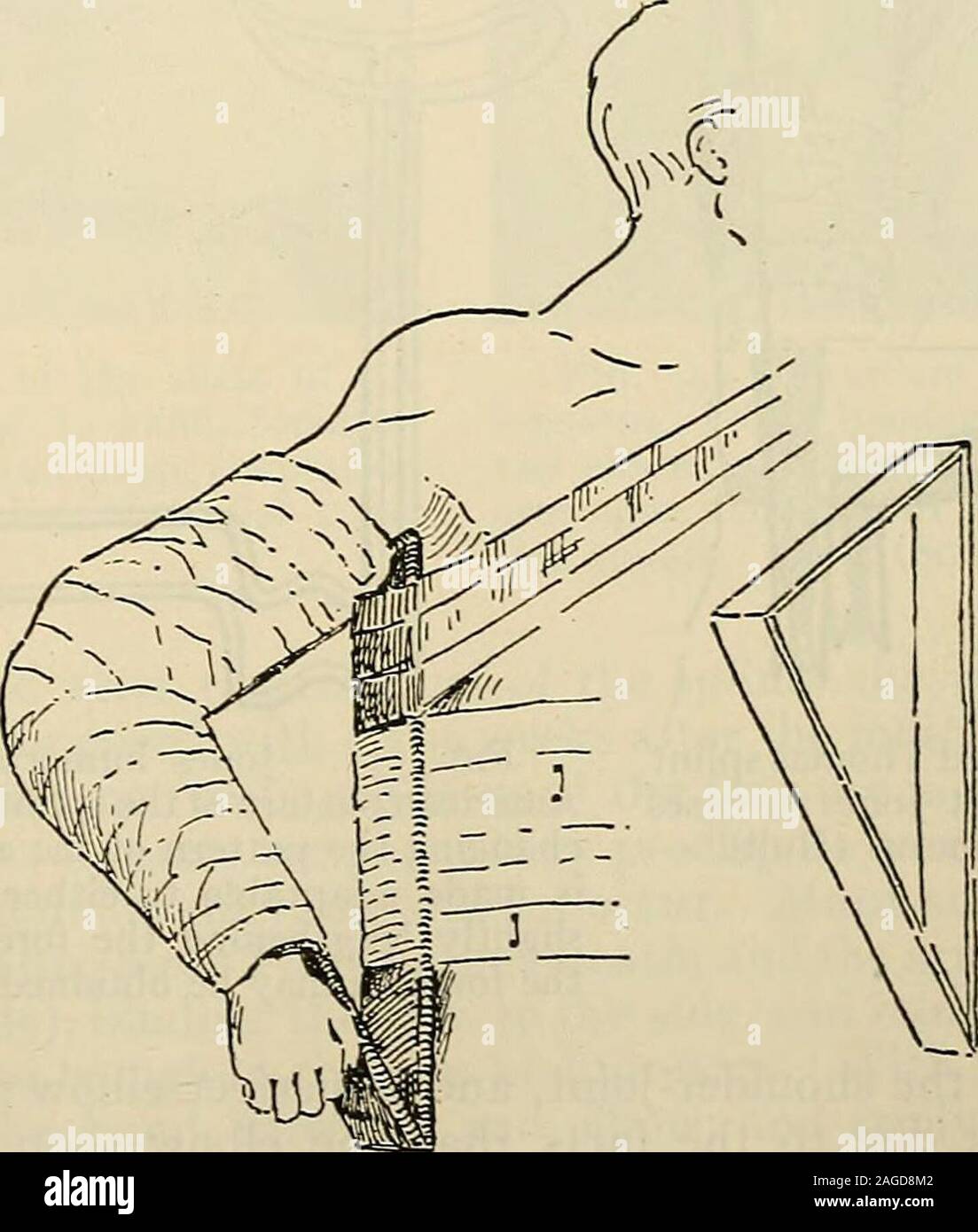 . Modern surgery, general and operative. Fig. 353.—Fracture of middle ...