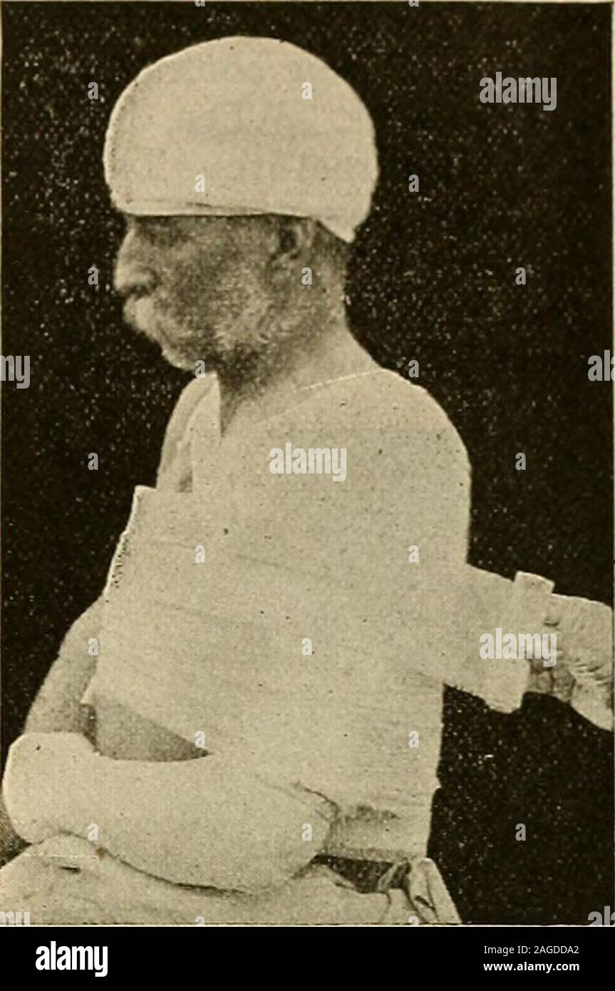 Right humerus fracture hi-res stock photography and images - Alamy