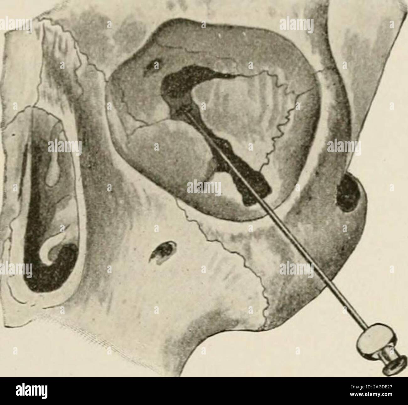 . Local and regional anesthesia; with chapters on spinal, epidural ...