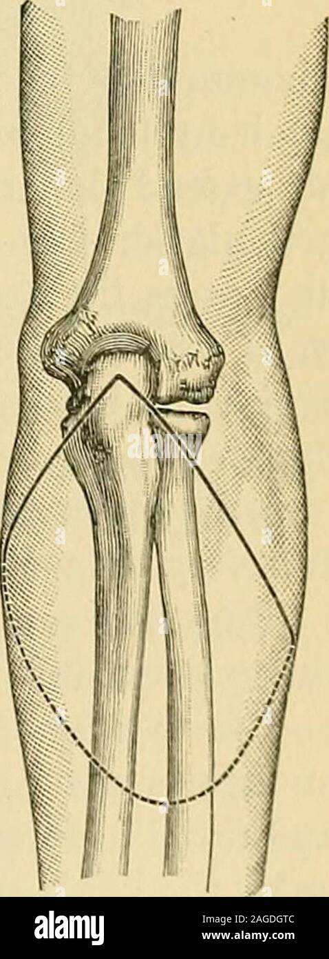 Incision made through the skin hi-res stock photography and images - Alamy