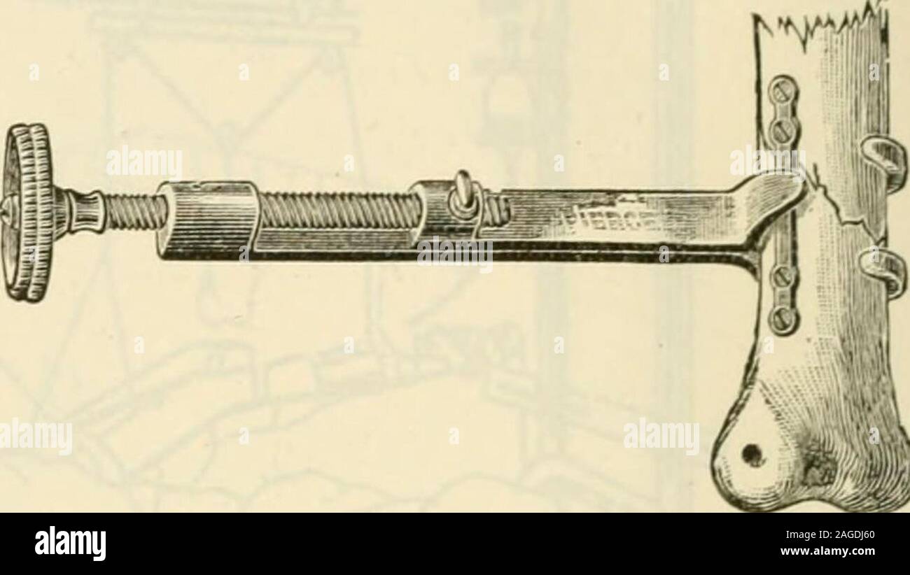 . Modern surgery, general and operative. Fig. 327.—Lowman-Lambotte bone ...