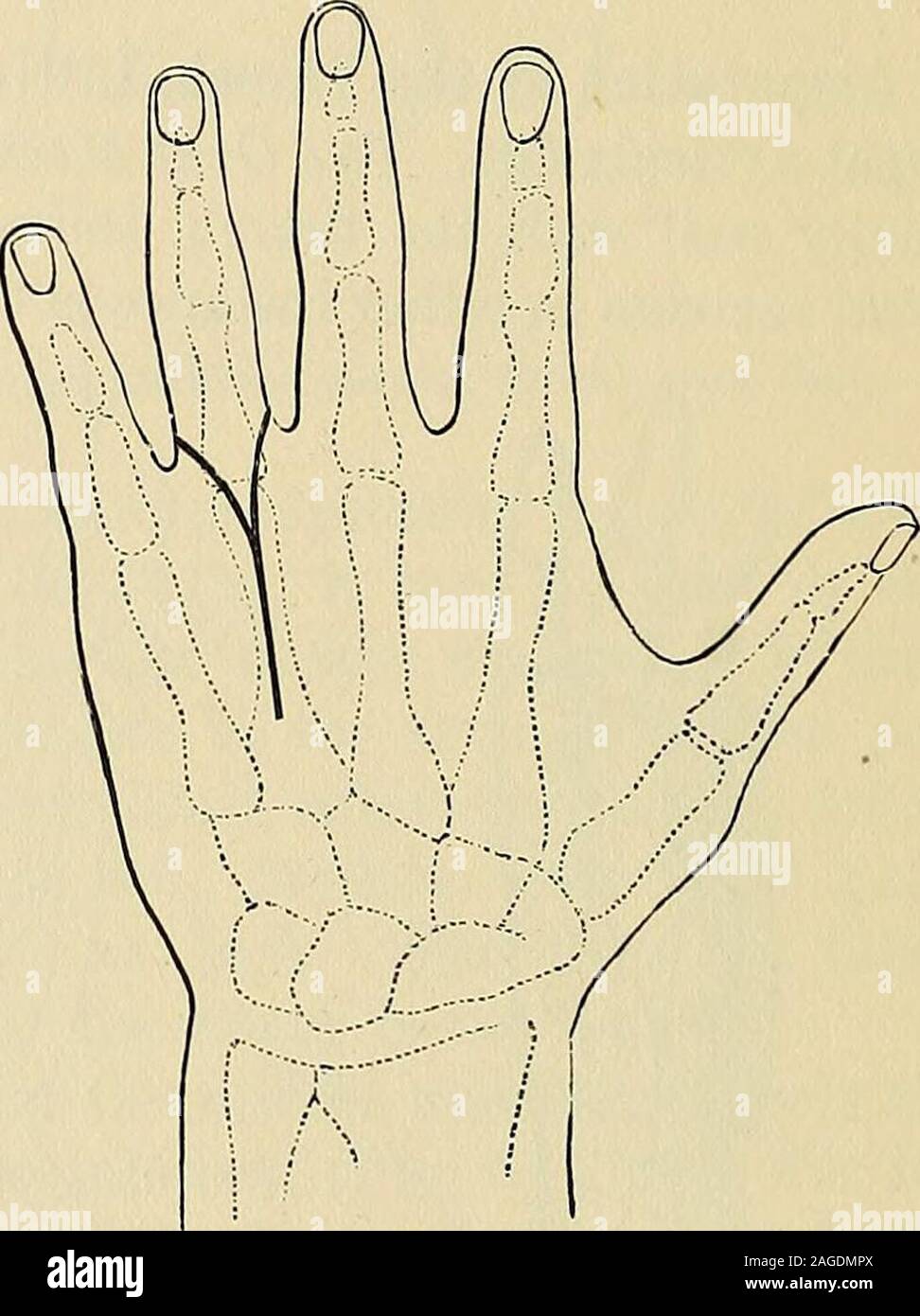 . Operative surgery. Fig. 520.—Amputation through fourthand fifth ...
