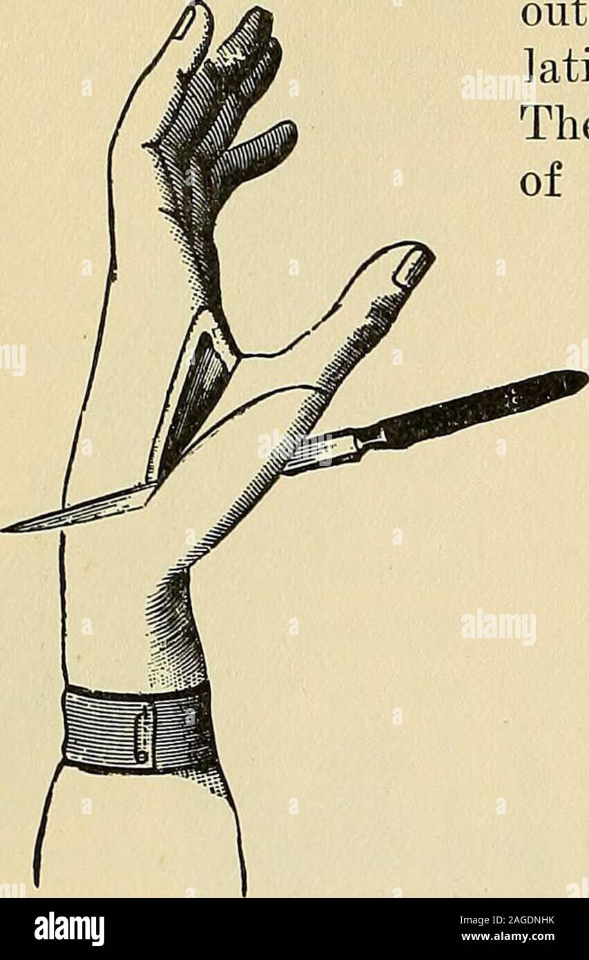 One finger removed hi-res stock photography and images - Alamy