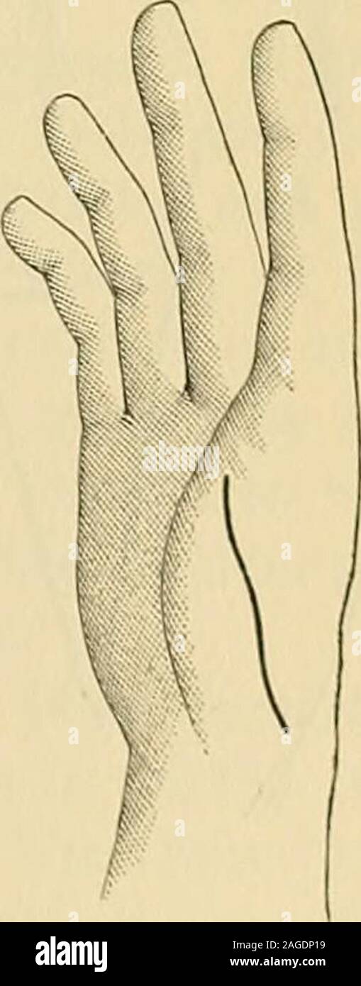 One finger removed hi-res stock photography and images - Alamy