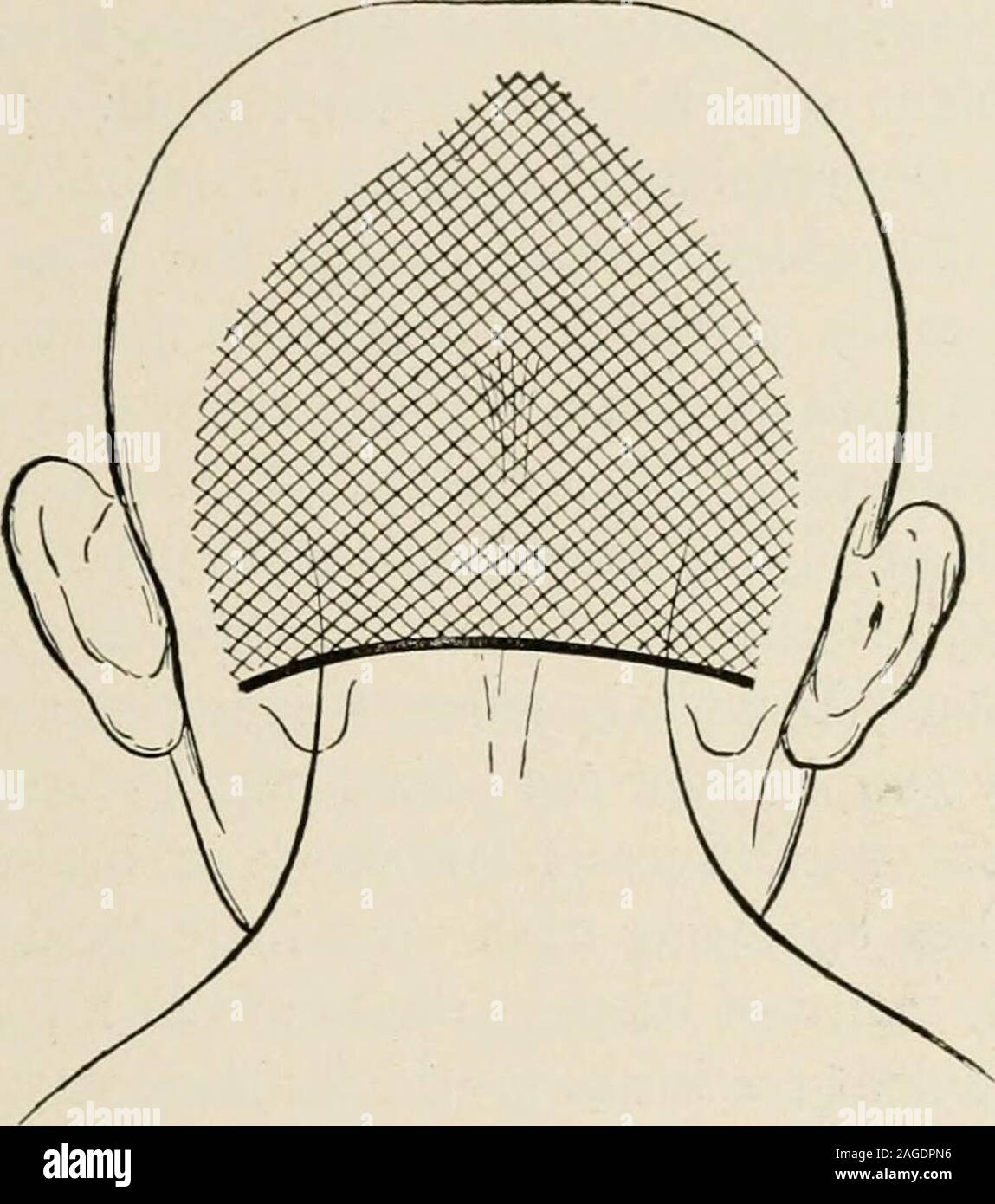 . Local and regional anesthesia; with chapters on spinal, epidural ...