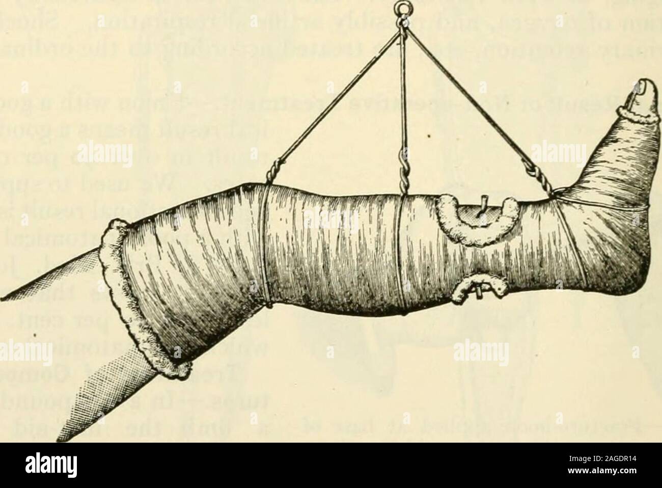 . Modern surgery, general and operative. for amputation. 1. If the skin ...