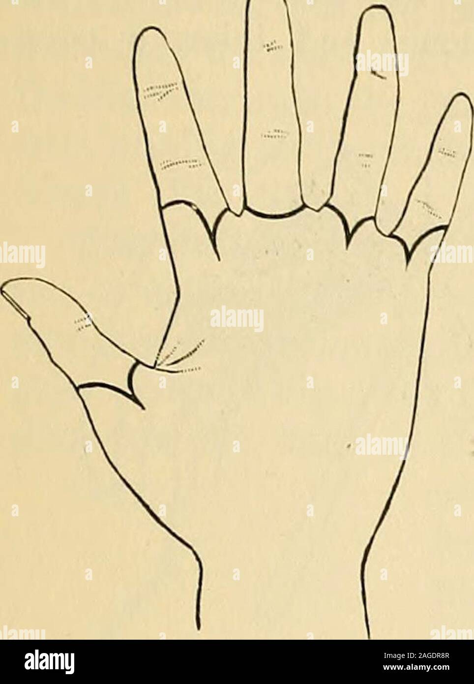 One finger removed hi-res stock photography and images - Alamy