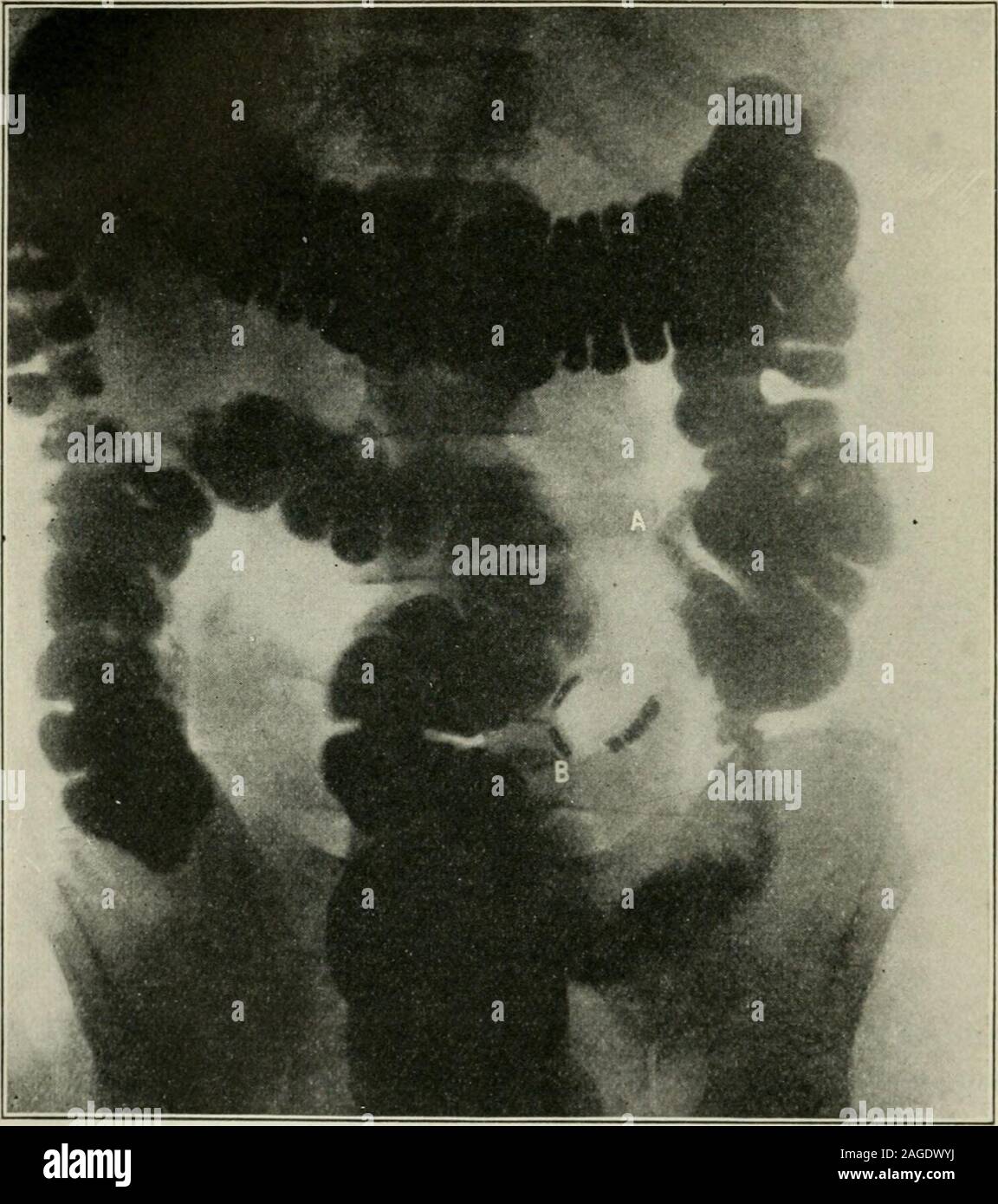 Coolidge x ray tube hi-res stock photography and images - Alamy