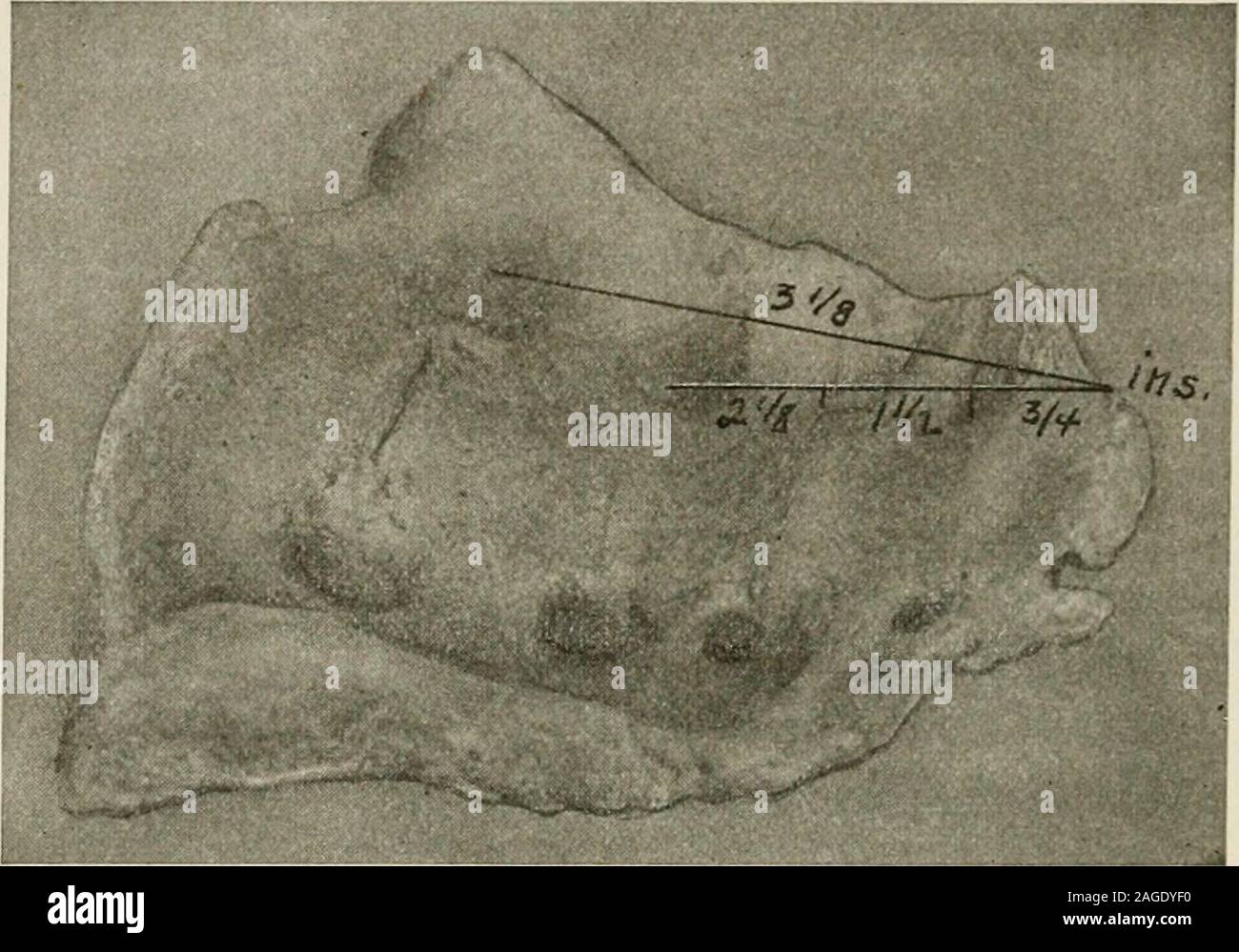 . Local and regional anesthesia; with chapters on spinal, epidural ...