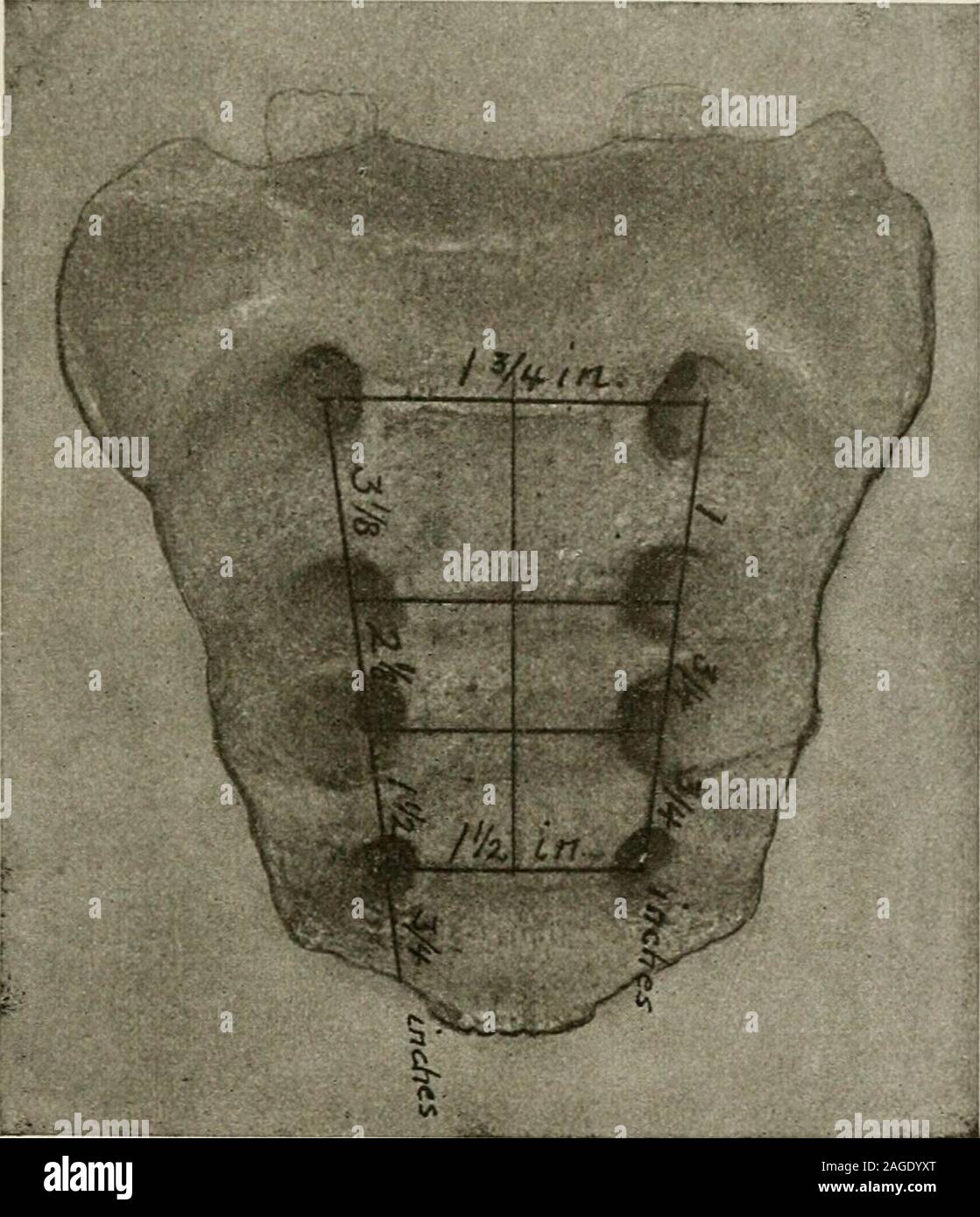 . Local and regional anesthesia; with chapters on spinal, epidural ...