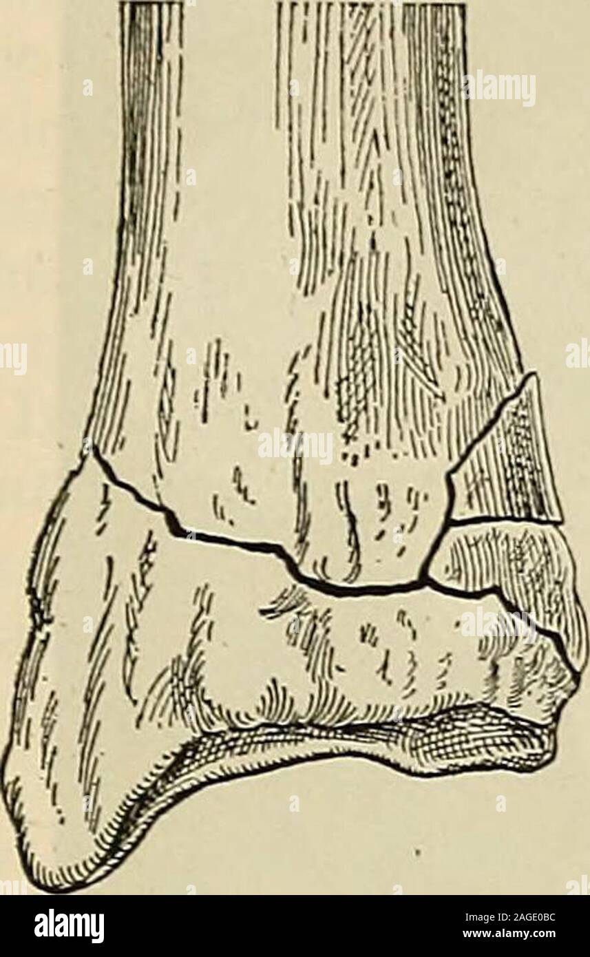 Transverse bone fracture hi-res stock photography and images - Alamy