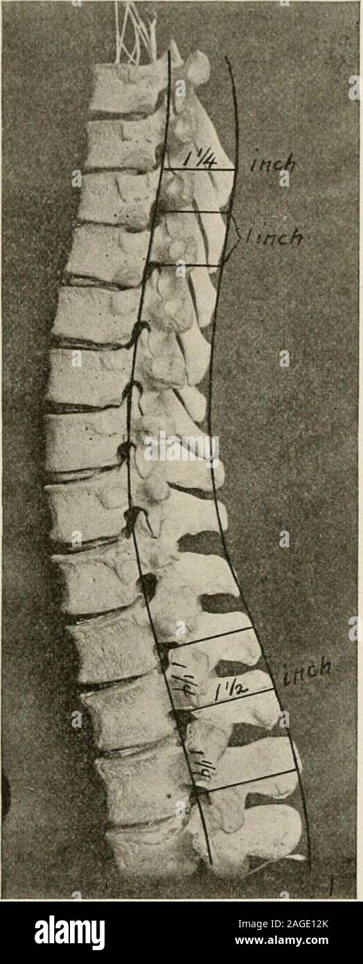 . Local and regional anesthesia; with chapters on spinal, epidural ...