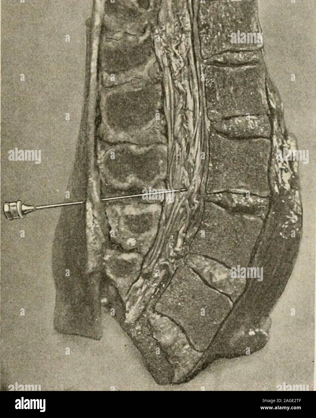 Epidural space hi-res stock photography and images - Alamy