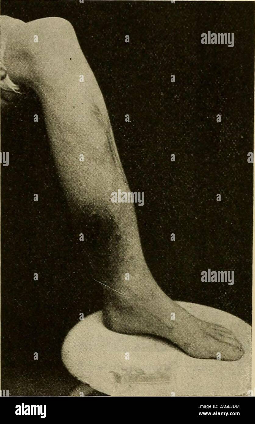 . Modern surgery, general and operative. ion andloosening of a ...