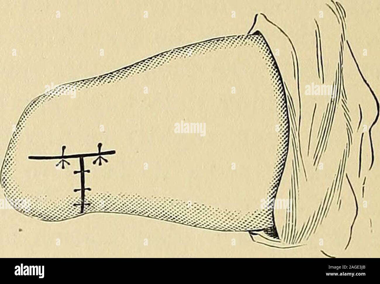 Anterior posterior flaps hi-res stock photography and images - Alamy