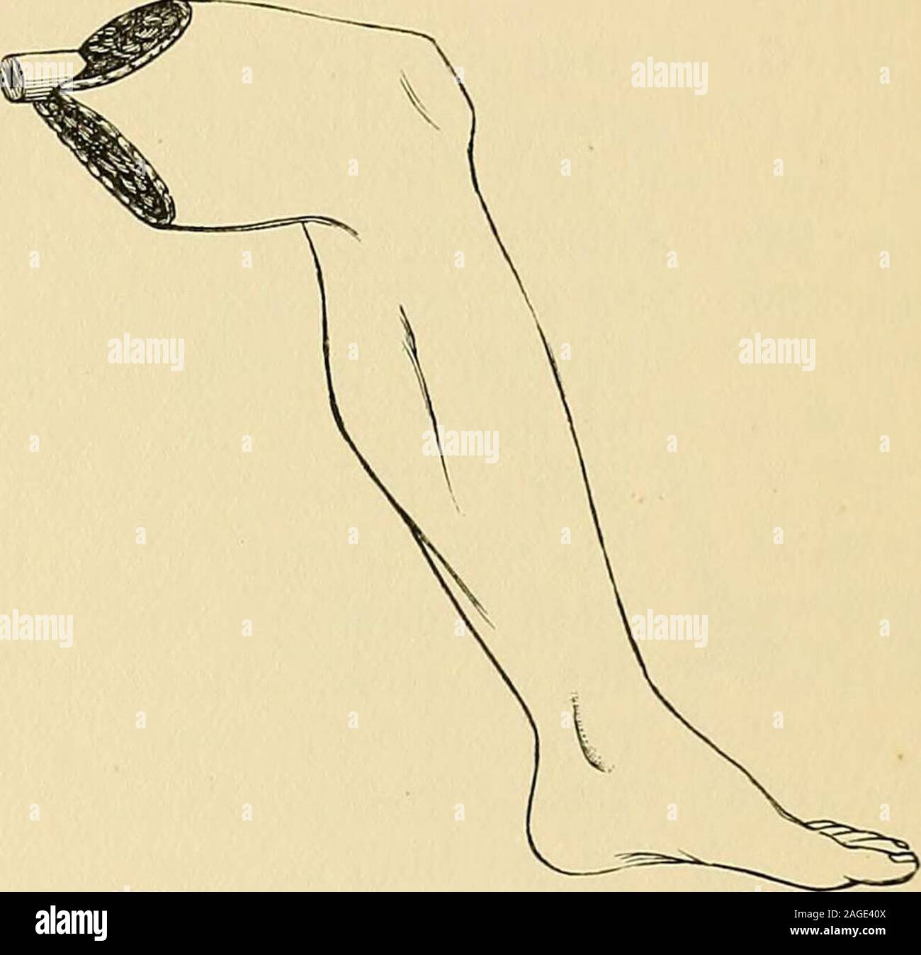 Anterior posterior flaps hi-res stock photography and images - Alamy