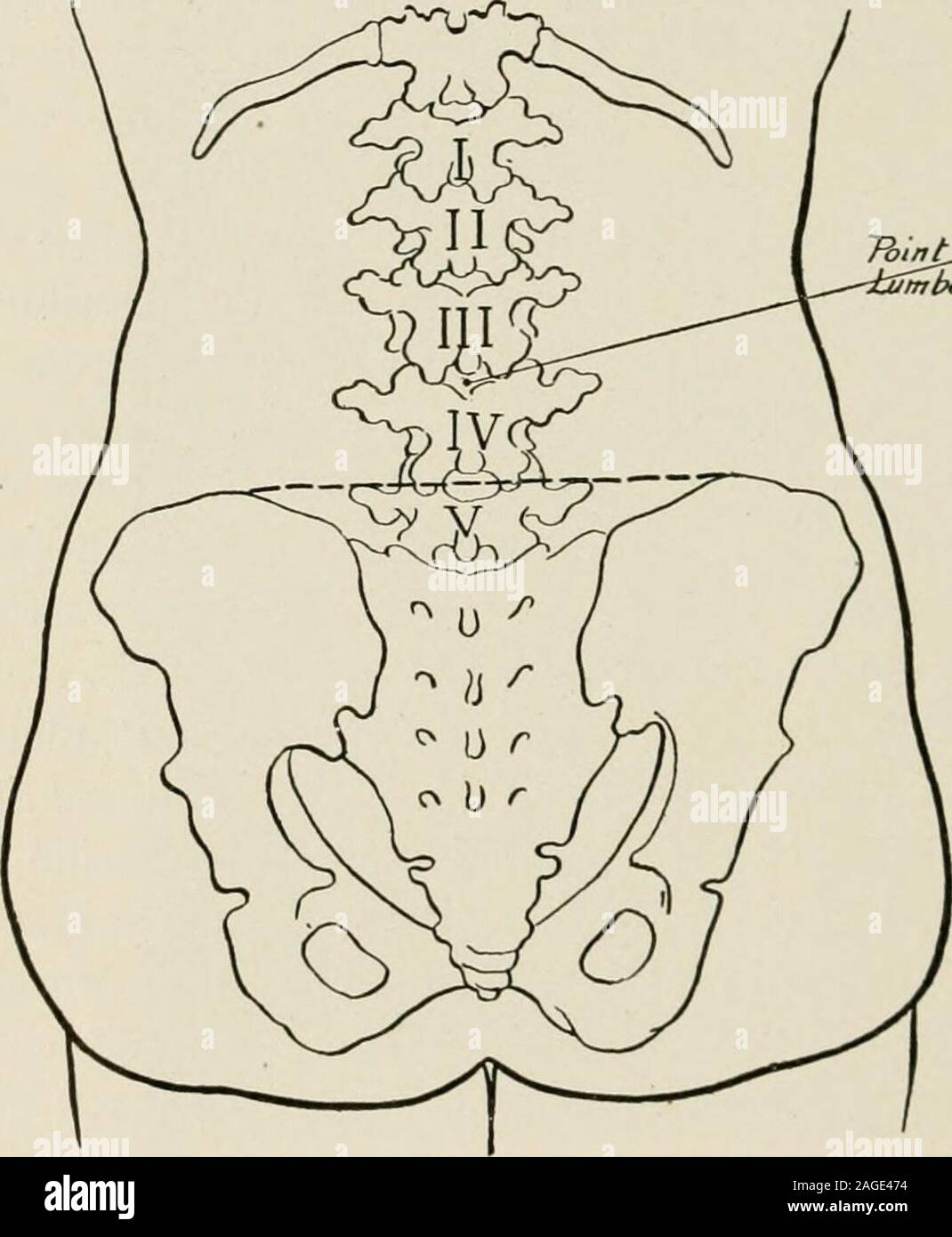 . Local and regional anesthesia; with chapters on spinal, epidural ...