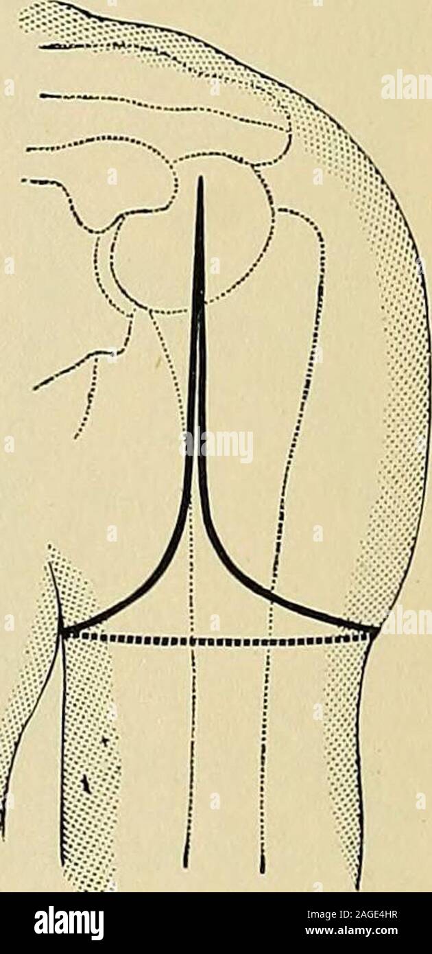 . Operative surgery. ^ The Oval or Racket Method.—The oval or ...