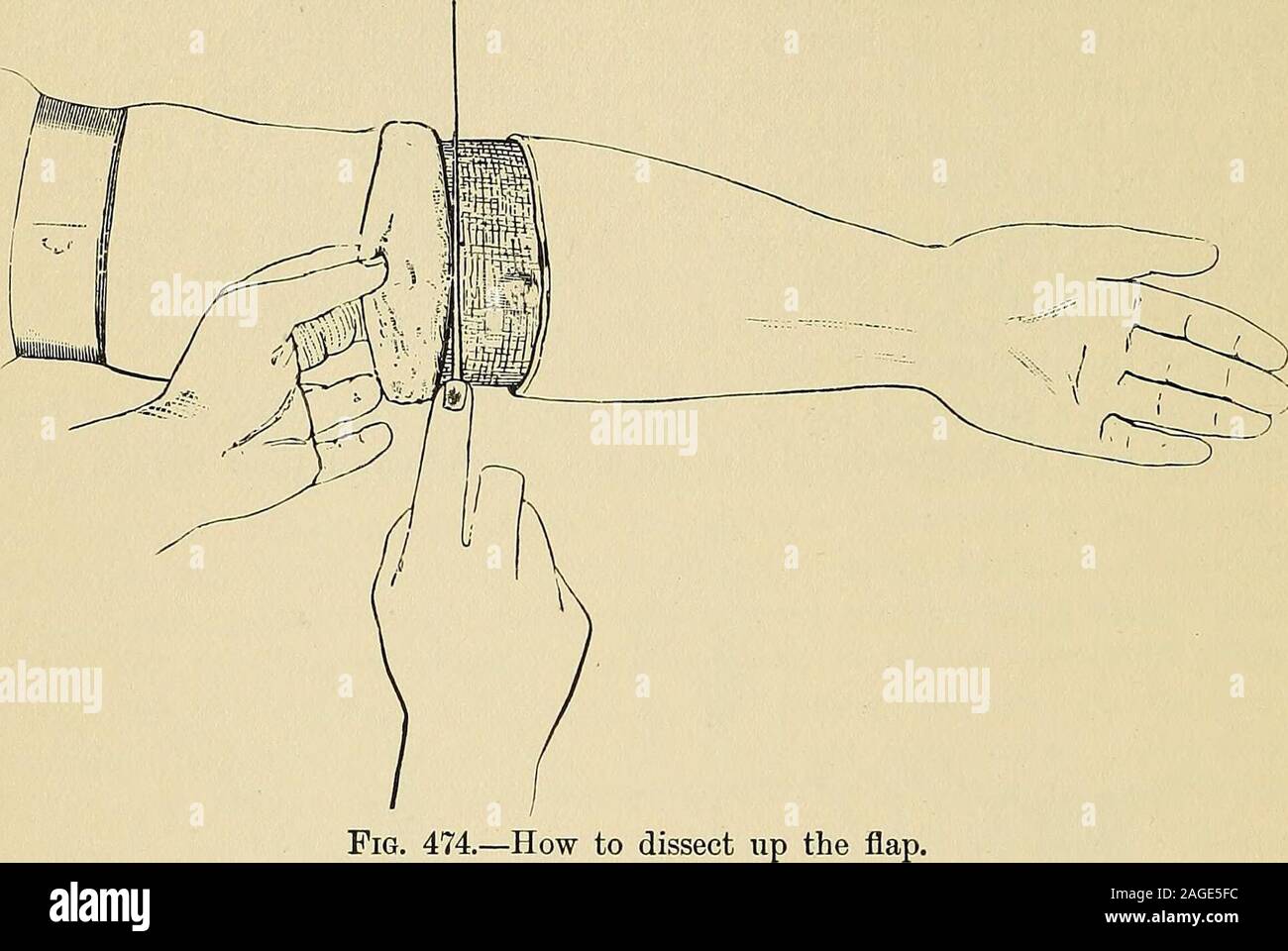 . Operative surgery. ps of excessive length and suitably trim ...