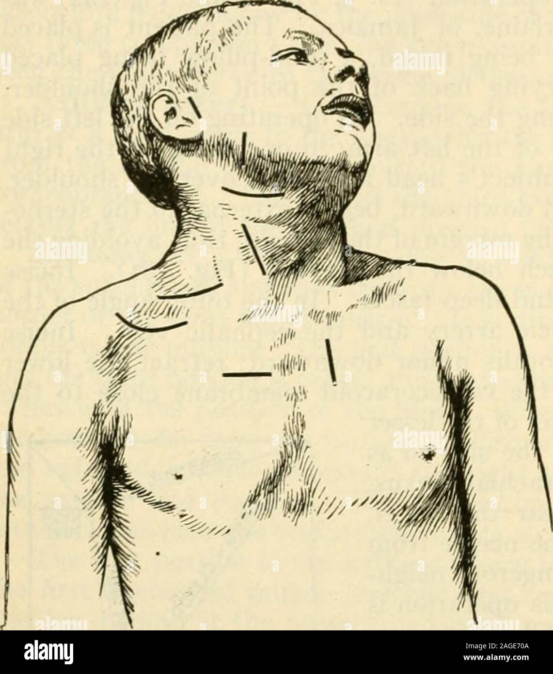 . Modern surgery, general and operative. 4 inch above the collar-bone ...