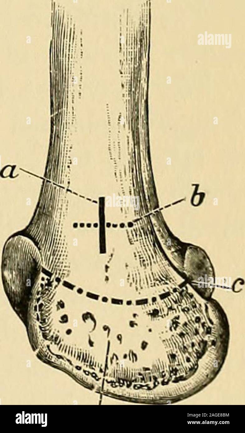 Osteotomies hi-res stock photography and images - Alamy