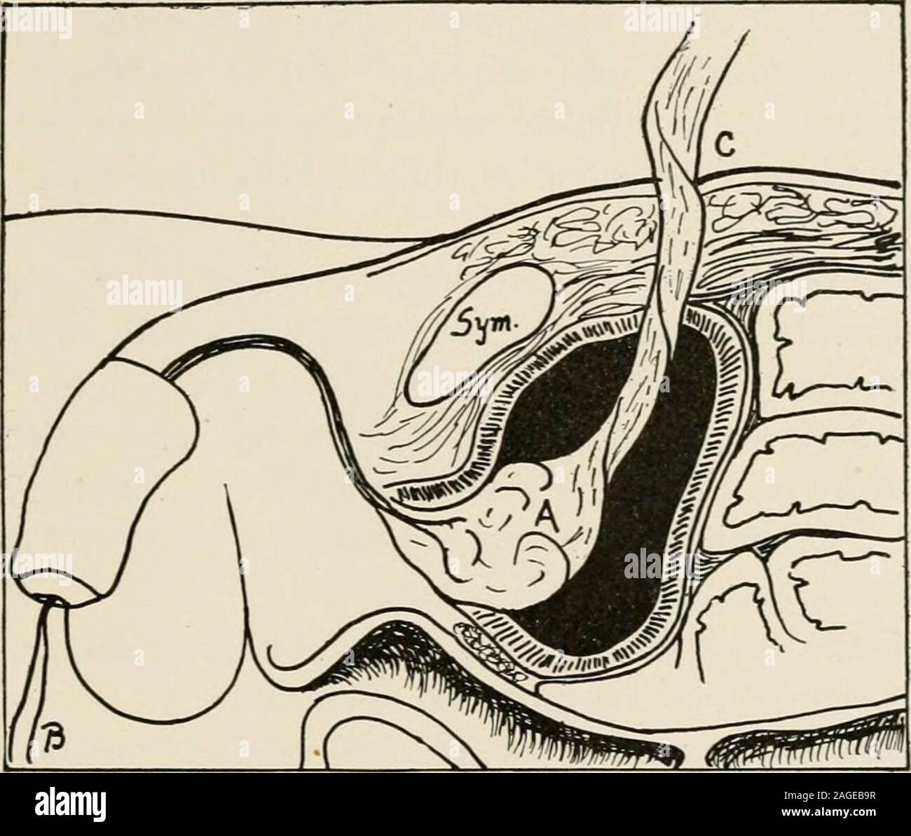 . Local and regional anesthesia; with chapters on spinal, epidural ...