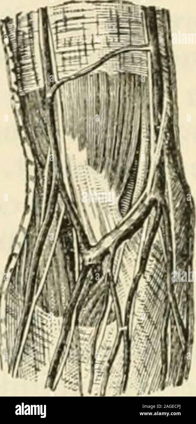 Venesection hi-res stock photography and images - Alamy