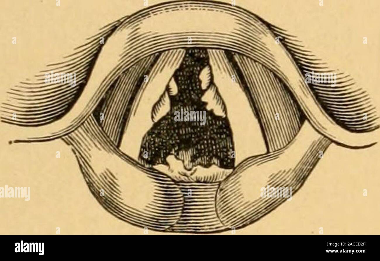 . A manual of diseases of the nose and throat. us membraneof the larynx ...