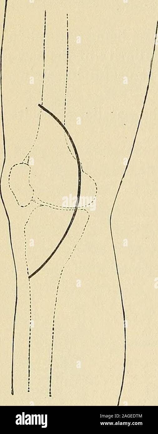 Flap excision hi-res stock photography and images - Alamy