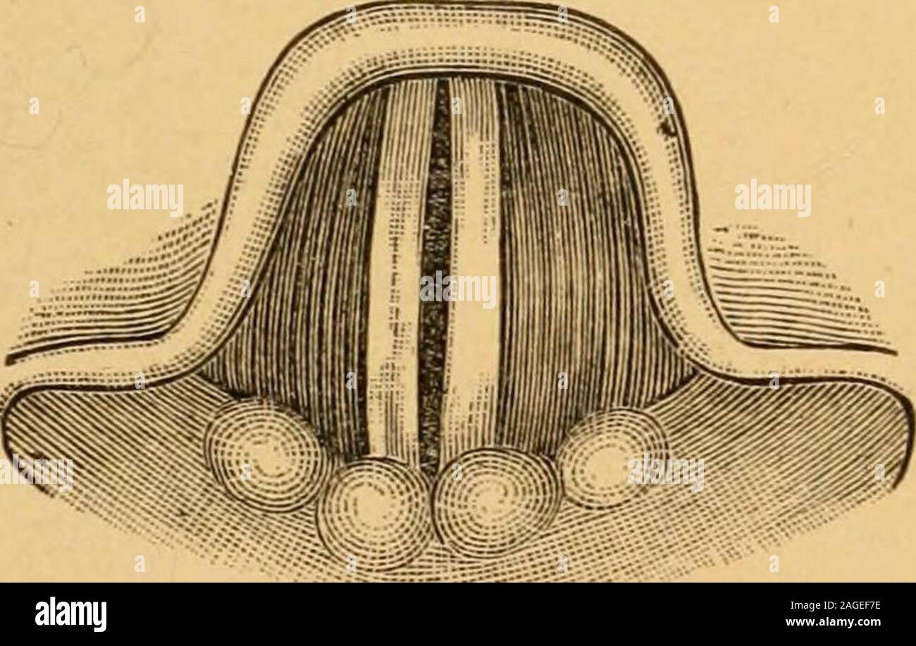 Severe laryngitis hi-res stock photography and images - Alamy