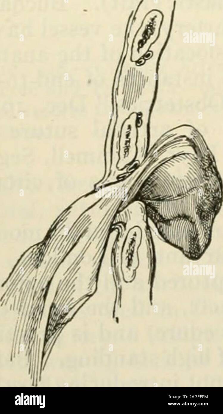 . Modern surgery, general and operative. ill stop capillary bleeding. A ...