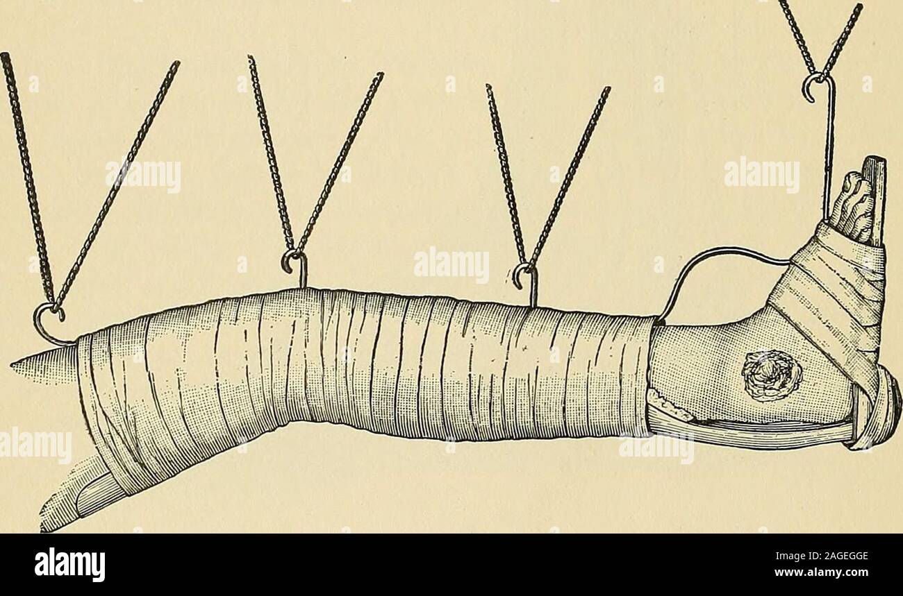 . Operative surgery. he fragments of the os calcis are placed in ...