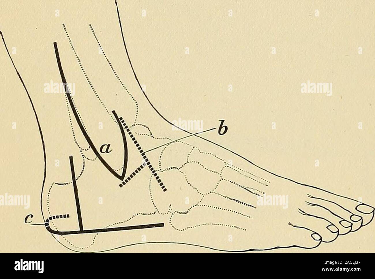 Excision of astragalus hi-res stock photography and images - Alamy