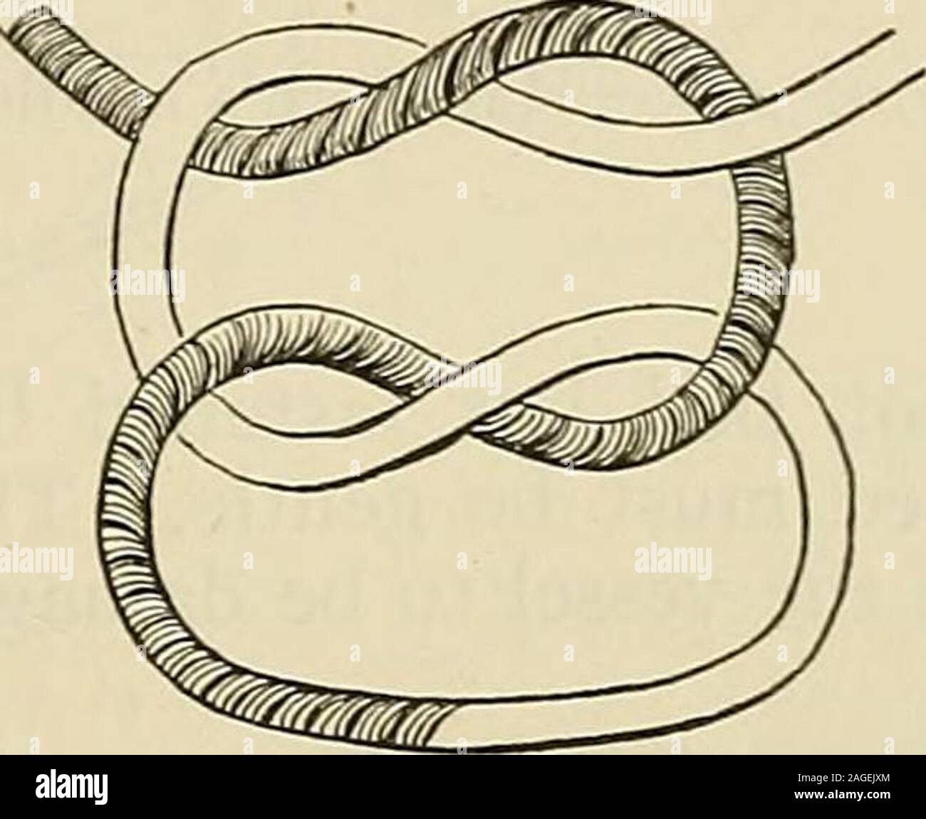 . Modern surgery, general and operative. Fig. 236.—Method of tying ...