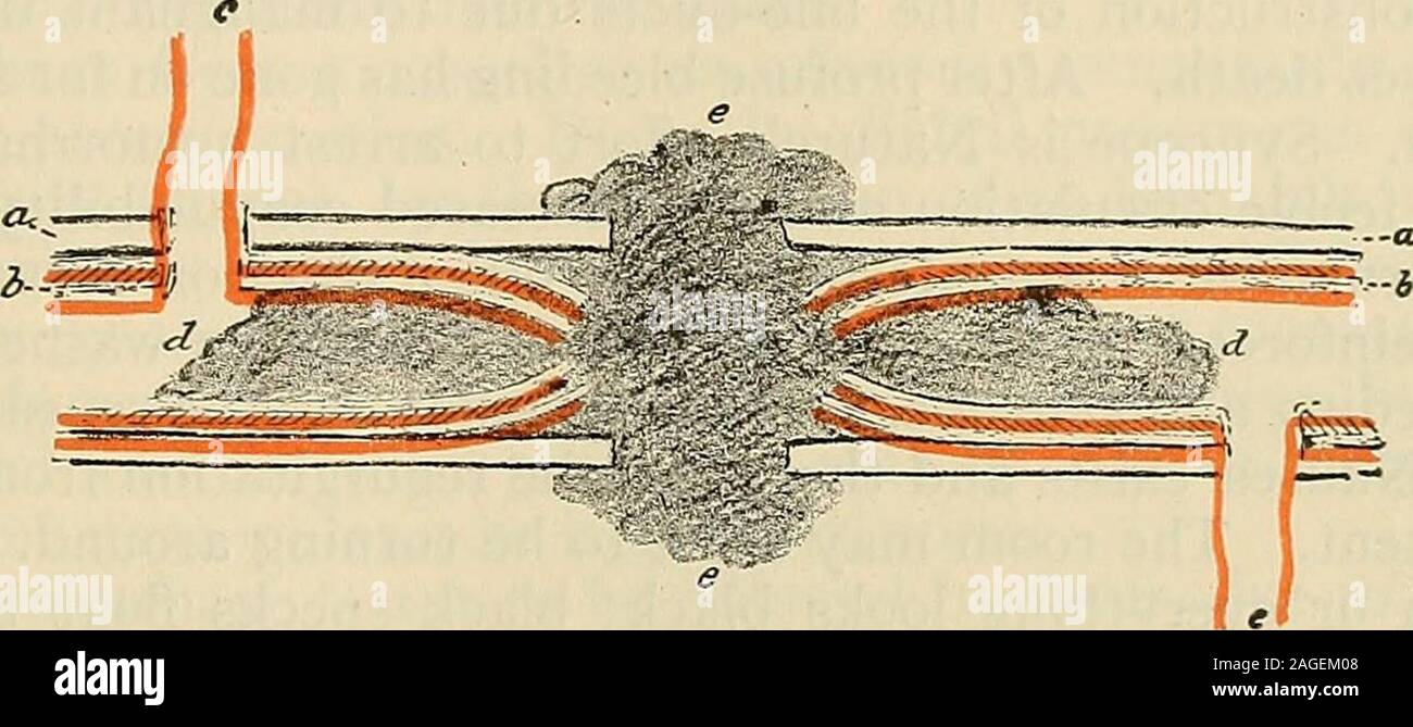 . Modern surgery, general and operative. rested. A tranverse wound ...