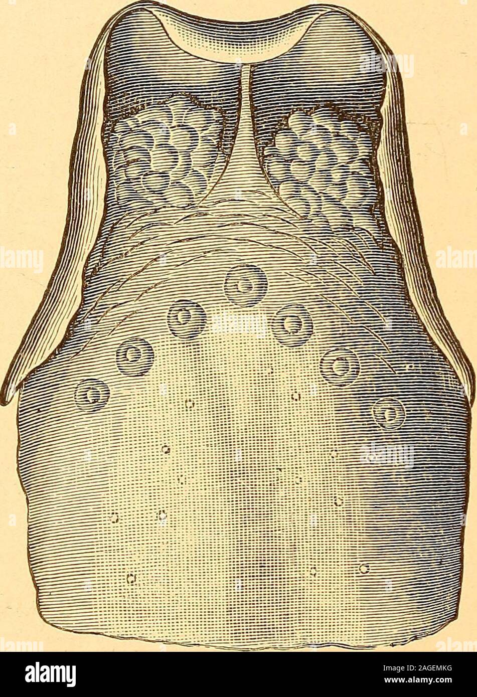 Lymphoid hypertrophy hi-res stock photography and images - Alamy